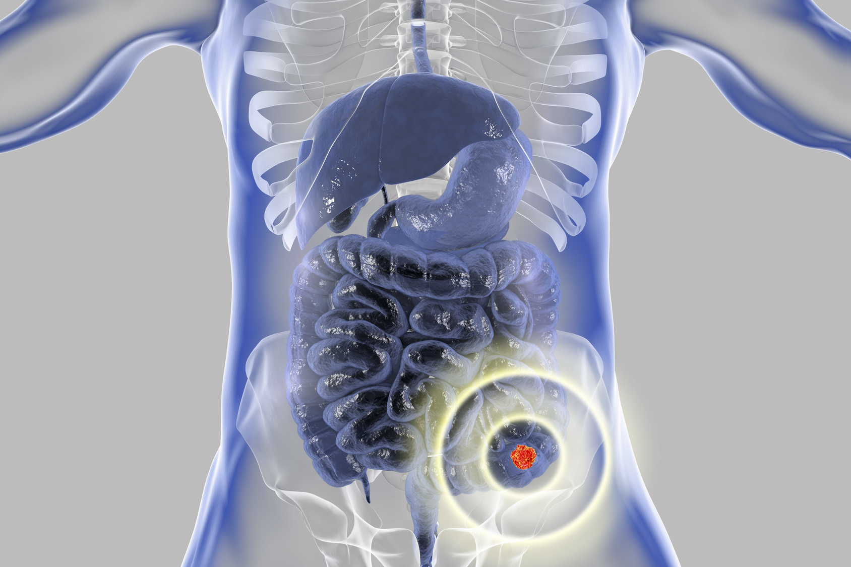 Mortality by stage for right vs. left-sided colon cancer - Health ...